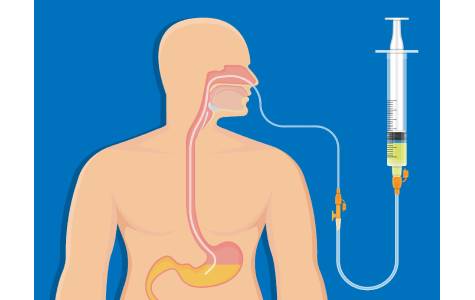 Apa Itu Prosedur Percutaneous Endoscopic Gastrostomy (PEG) Atau ...
