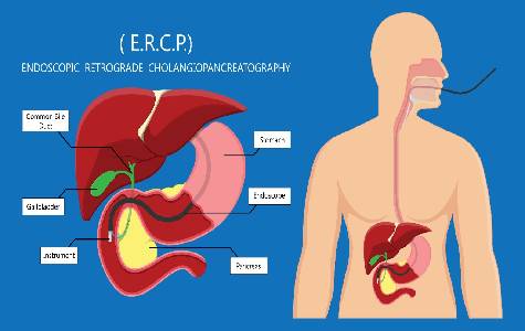 ERCP: Pengertian, Manfaat, Prosedur, dan Kapan Harus Periksa?