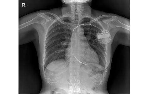 Alat Pacu Jantung: Jenis dan Cara Kerjanya - Eka Hospital