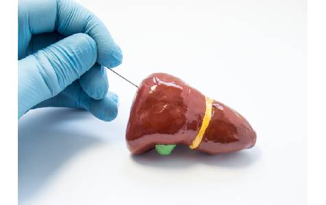Mengenal Biopsi Hati, Prosedur untuk Diagnosis dan Deteksi Penyakit ...