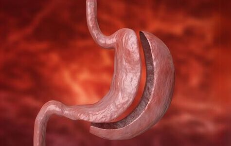 Operasi Bariatrik: Manfaat, Tahapan Prosedur, dan Efek Samping