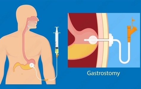Apa Itu Prosedur Percutaneous Endoscopic Gastrostomy (PEG) Atau ...