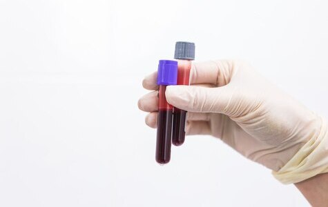 Mengenal Fungsi Plasma Darah dalam Perawatan PRP