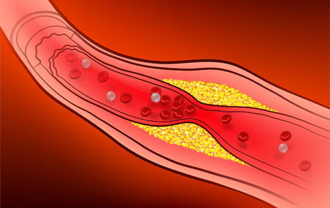 Apa itu Penyakit Arteri Perifer (PAD)?