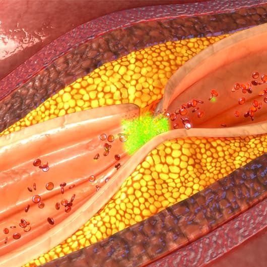 Terapi Trombolitik pada Stroke Infark (Sumbatan) - Eka Hospital